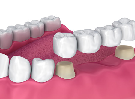 Zahnbrücke - Zahnarztzentrum Diez | Zahnarzt Diez